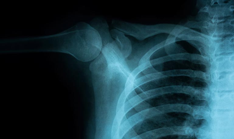 X-ray computed radiography (CR) | Hamamatsu Photonics