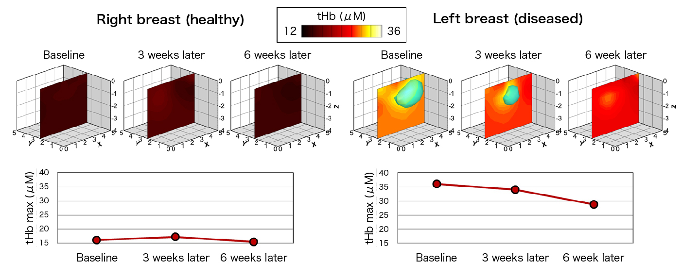 Optical mammography (Detecting and monitoring the breast cancer):Health ...